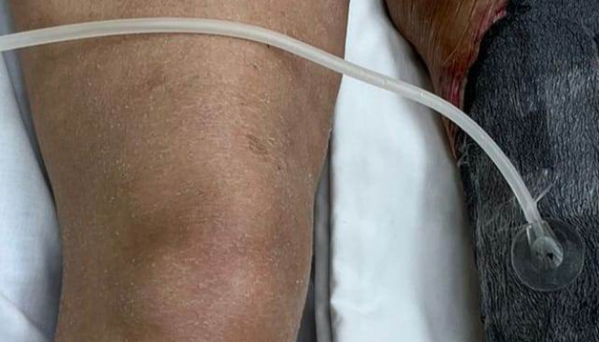 HGP utiliza o curativo a vácuo para tratamento de feridas complexas