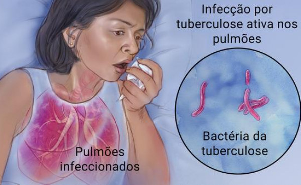 Saúde mobiliza municípios no Dia Mundial de Combate a Tuberculose